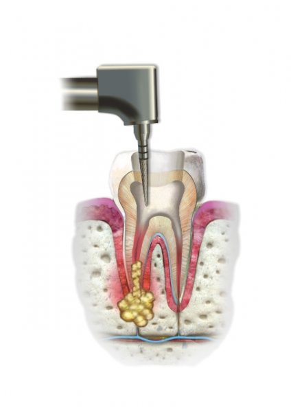 Endo Solution 17% EDTA 200ml + dispenser