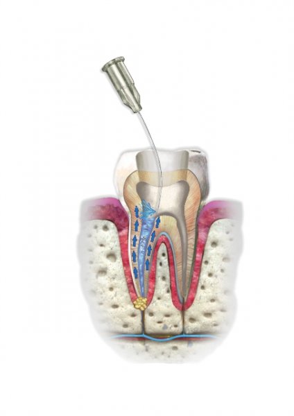 Endo Solution 17% EDTA 200ml + dispenser