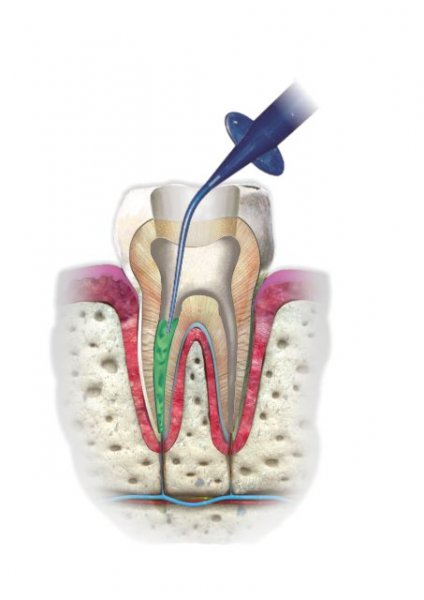 Endo Solution 17% EDTA 200ml + dispenser